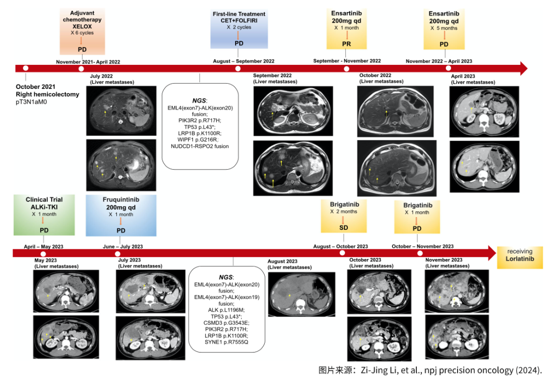 ALK基因阳性的肠癌，靶向药布加替尼和劳拉替尼有治疗效果！医药新闻-ByDrug-一站式医药资源共享中心-医药魔方