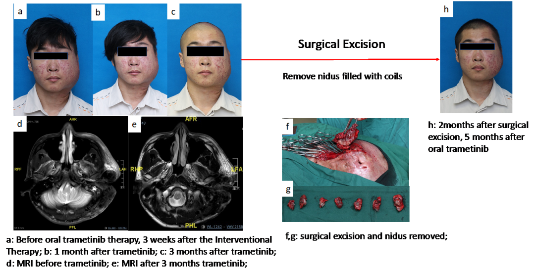 【医诺学院】曲美替尼治疗Ras/Raf/Mek通路上突变的颅外动静脉畸形获得明显临床效果医药新闻-ByDrug-一站式医药资源共享中心-医药魔方