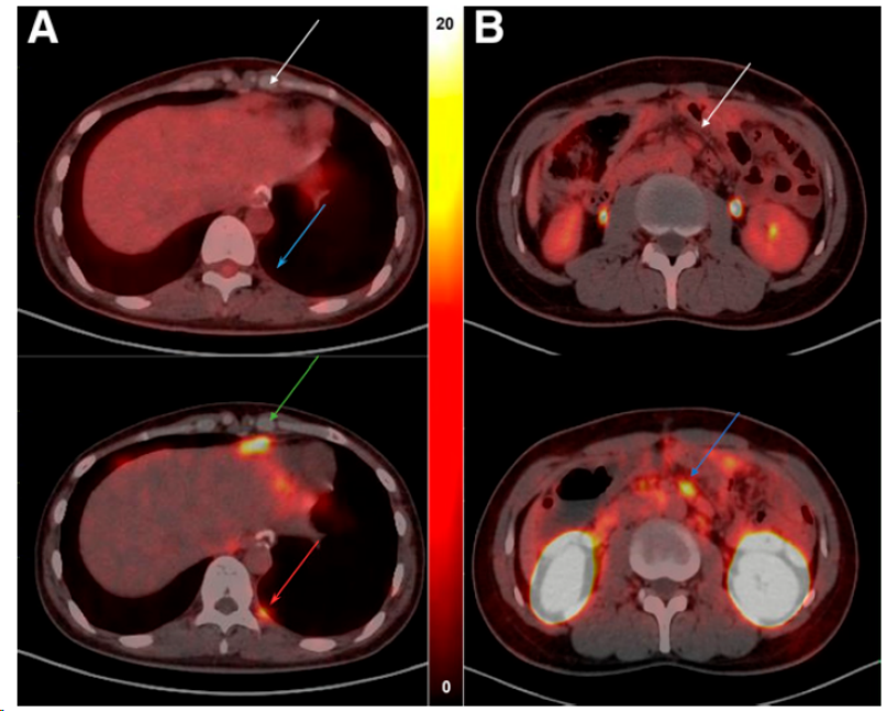 J Nucl Med | 北肿消化肿瘤Claudin18.2靶向PET显像：精准无创定位全身病灶医药新闻-ByDrug-一站式医药资源共享中心-医药魔方