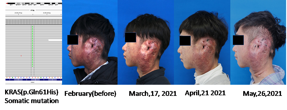 【医诺学院】曲美替尼治疗Ras/Raf/Mek通路上突变的颅外动静脉畸形获得明显临床效果医药新闻-ByDrug-一站式医药资源共享中心-医药魔方