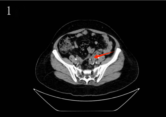FAPI-PET/CT：精准捕捉腹膜转移癌的“神探”医药新闻-ByDrug-一站式医药资源共享中心-医药魔方