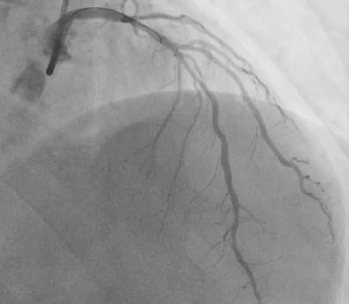 国内首例！医院心内科张必利教授团队利用DFR测定诊断新技术为冠心病患者提供精准诊疗医药新闻-ByDrug-一站式医药资源共享中心-医药魔方