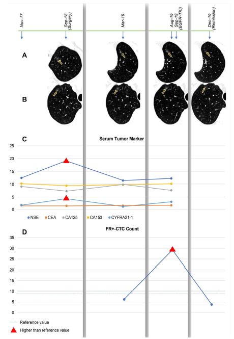 【2750】中国好声音 | 广医一院何建行团队连续发文证实：EGFR靶向治疗对早期磨玻璃样肺癌（GGO）有效医药新闻-ByDrug-一站式医药资源共享中心-医药魔方