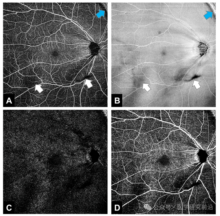 Prog. Retin. Eye Res.重磅综述！告别传统！OCTA眼科血管成像精准诊断系统性疾病，但挑战依然存在！医药新闻-ByDrug-一站式医药资源共享中心-医药魔方