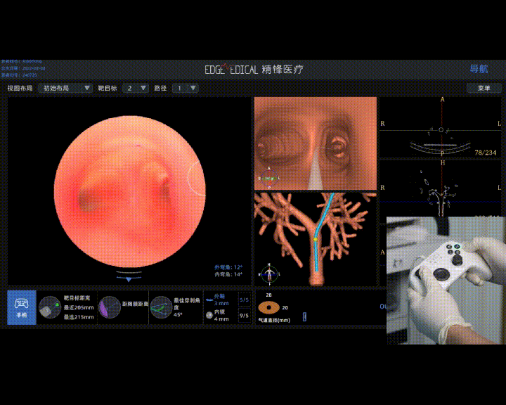 正事 | 精锋®支气管镜机器人CP1000获NMPA上市批准！在微创-微无创手术领域取得全面突破！医药新闻-ByDrug-一站式医药资源共享 ...