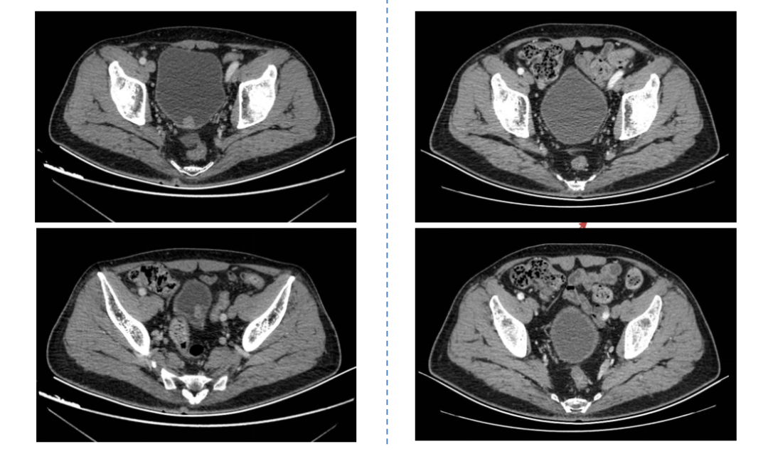 潜力无限，ADC单药新辅助治疗多发高级别Her2过表达MIBC患者6周期达CR，成功保留膀胱医药新闻-ByDrug-一站式医药资源共享中心-医药魔方
