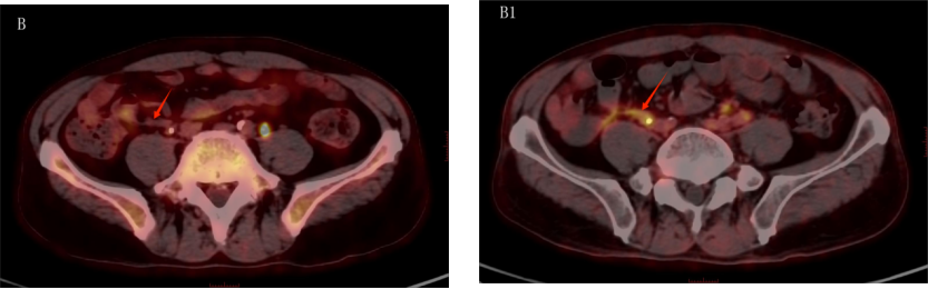 FAPI-PET/CT：精准捕捉腹膜转移癌的“神探”医药新闻-ByDrug-一站式医药资源共享中心-医药魔方