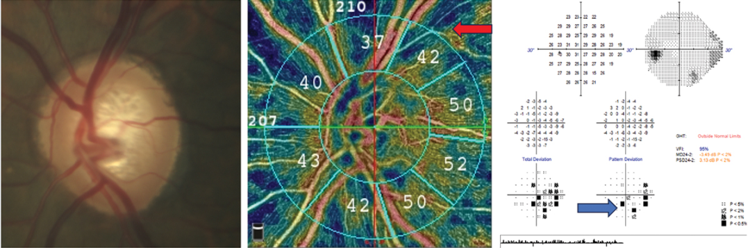 OCT生物标志物研究速览（一）：青光眼医药新闻-ByDrug-一站式医药资源共享中心-医药魔方