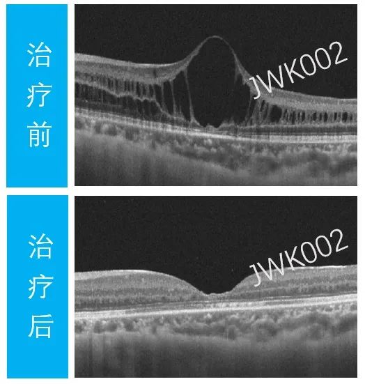金唯科针对X连锁视网膜劈裂症的基因治疗药物JWK002获IND受理医药新闻-ByDrug-一站式医药资源共享中心-医药魔方