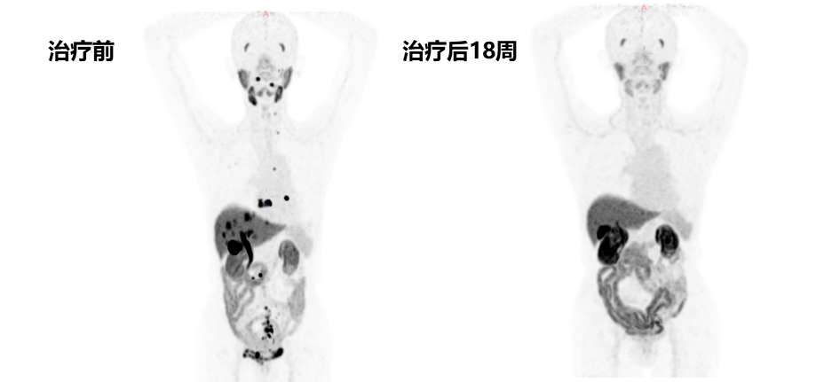 云南白药集团创新核药INR102注射液首次人体试验展现良好治疗效果医药新闻-ByDrug-一站式医药资源共享中心-医药魔方