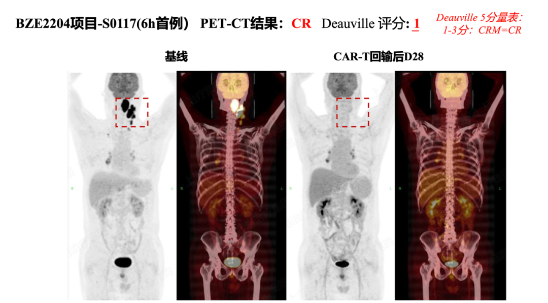 6小时完成CAR-T制备，上海细胞治疗集团三靶点CAR-T治疗首例病人快速获得完全缓解医药新闻-ByDrug-一站式医药资源共享中心-医药魔方