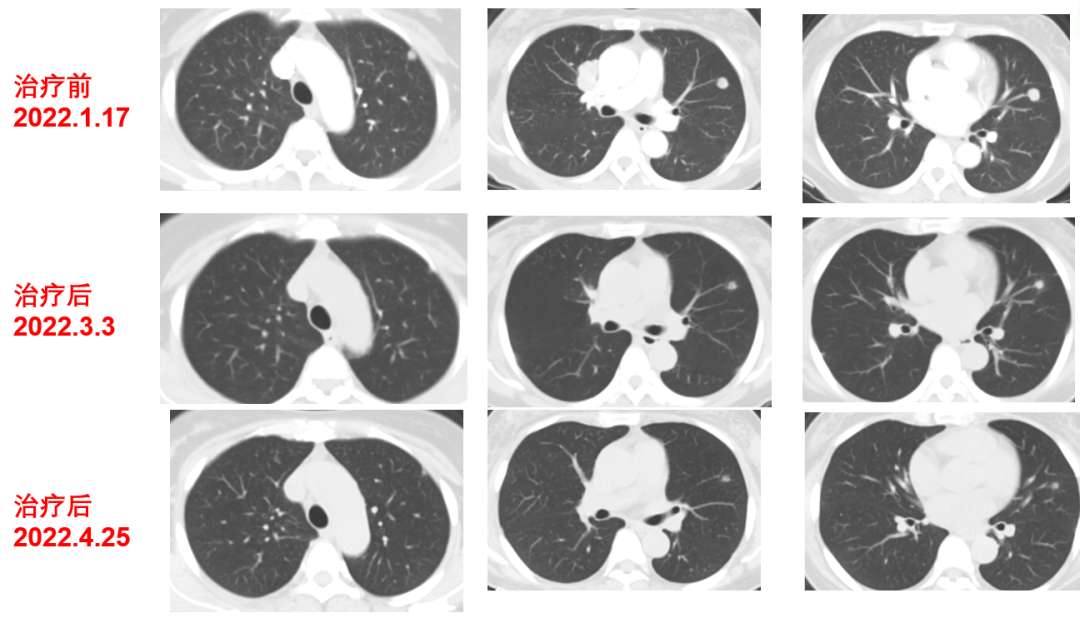 集思广益：MDT和MTB共同助力改善HER-2扩增晚期结直肠癌生存结局医药新闻-ByDrug-一站式医药资源共享中心-医药魔方