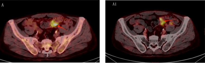 FAPI-PET/CT：精准捕捉腹膜转移癌的“神探”医药新闻-ByDrug-一站式医药资源共享中心-医药魔方