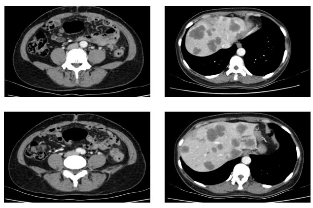 集思广益：MDT和MTB共同助力改善HER-2扩增晚期结直肠癌生存结局医药新闻-ByDrug-一站式医药资源共享中心-医药魔方