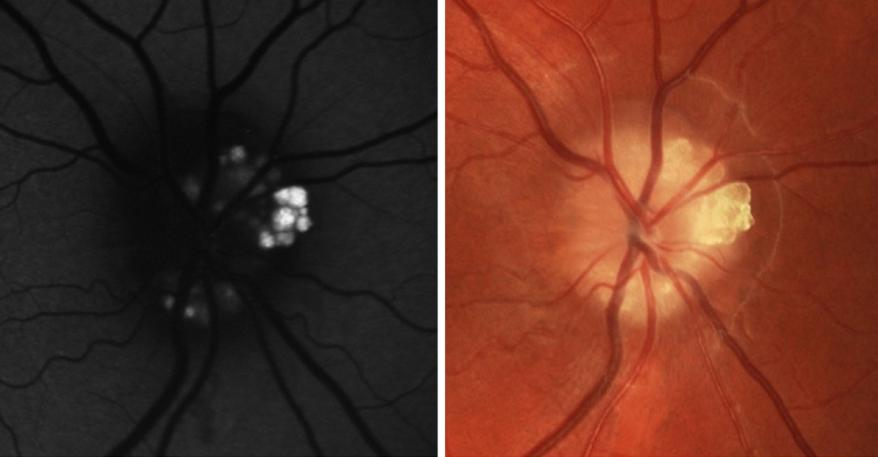 EDI-OCT扫描：最新研究发现视盘玻璃疣随年龄增长“现身”的幕后推手医药新闻-ByDrug-一站式医药资源共享中心-医药魔方
