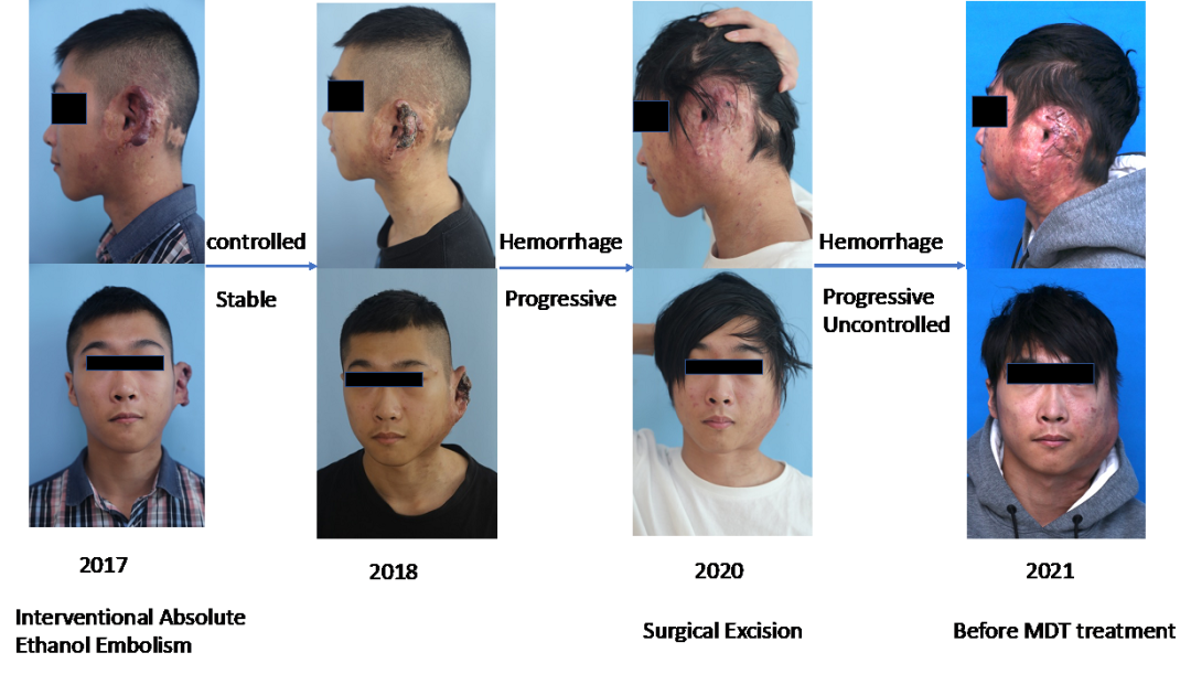 【医诺学院】曲美替尼治疗Ras/Raf/Mek通路上突变的颅外动静脉畸形获得明显临床效果医药新闻-ByDrug-一站式医药资源共享中心-医药魔方