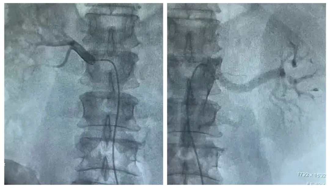 RDN来了！高血压治疗新技术医药新闻-ByDrug-一站式医药资源共享中心-医药魔方