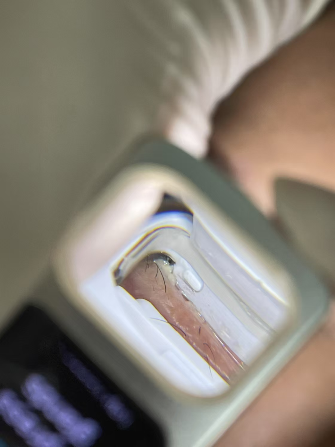 【光热脉动真实世界】屈光白内障术后MGD干眼：光热脉动联合疗法实现精准干预医药新闻-ByDrug-一站式医药资源共享中心-医药魔方