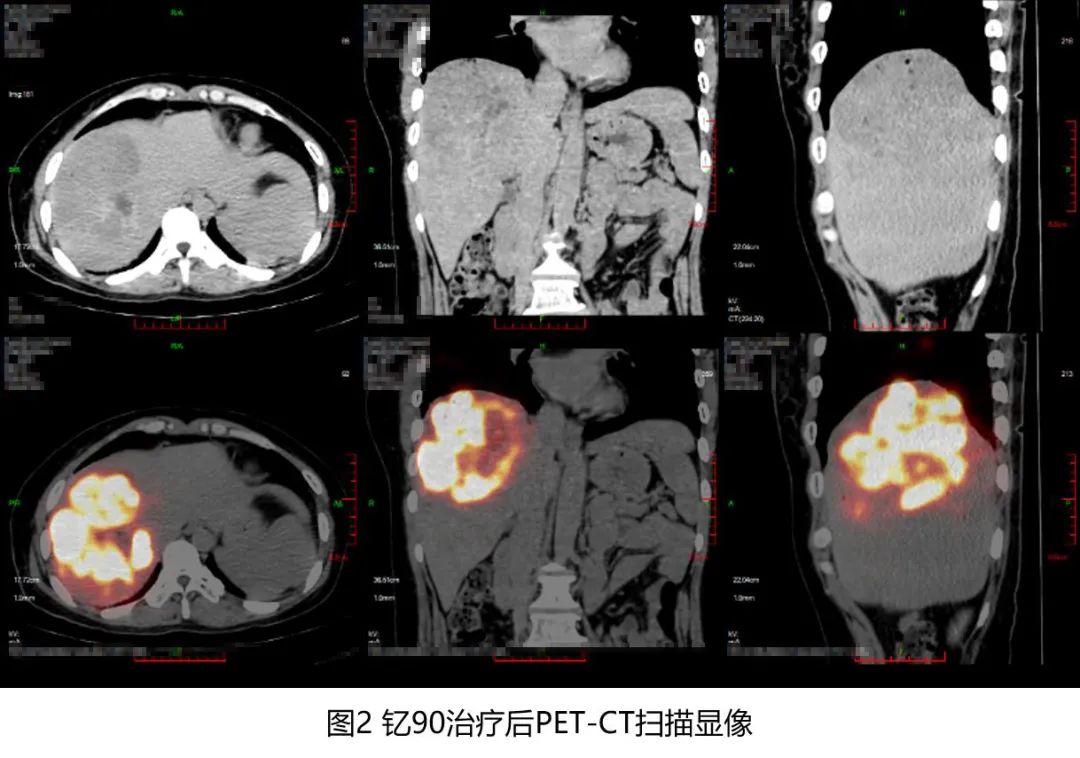 【肿瘤与血管介入微创治疗中心·医疗案例】钇90-SIRT助力肝癌转化，为不可切除肝癌带来新的选择医药新闻-ByDrug-一站式医药资源共享中心 ...