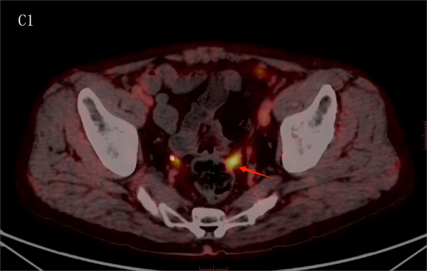 FAPI-PET/CT：精准捕捉腹膜转移癌的“神探”医药新闻-ByDrug-一站式医药资源共享中心-医药魔方