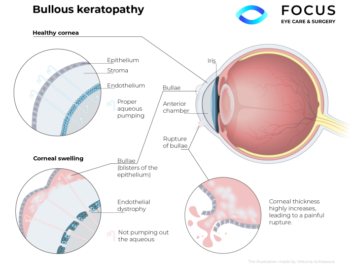 大疱性角膜病变患者的治疗之路：Vyznova 开启眼科细胞疗法新纪元医药新闻-ByDrug-一站式医药资源共享中心-医药魔方