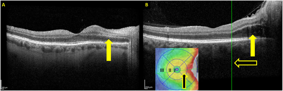 75%准确率！仅OCT就可以区分A - AION与NA - AION 研究概要医药新闻-ByDrug-一站式医药资源共享中心-医药魔方
