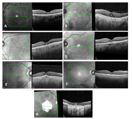 SD-OCT显示黄斑区出现高反射垂直线的潜在关联病因医药新闻-ByDrug-一站式医药资源共享中心-医药魔方