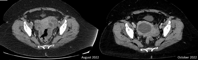 4例临床实例与进展梳理，探dMMR/MSI-H结直肠癌免疫转化治疗疗效与潜力医药新闻-ByDrug-一站式医药资源共享中心-医药魔方