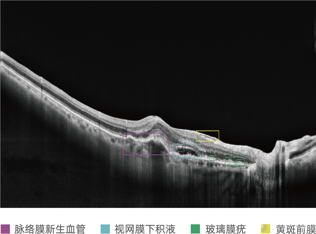比格威医疗MIAS-3000斩获全球首张医用OCT AI三类证，开启眼科精准诊疗新时代医药新闻-ByDrug-一站式医药资源共享中心-医药魔方