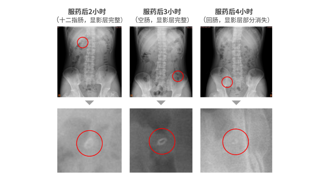 三迭纪IgA肾病药物产品D23取得积极临床结果，验证精准肠道靶向递送能力医药新闻-ByDrug-一站式医药资源共享中心-医药魔方
