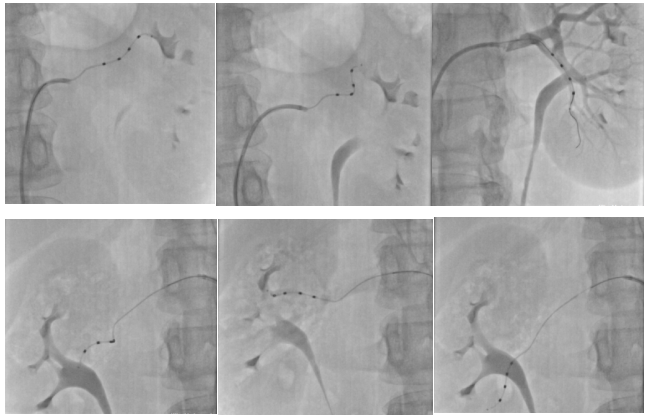 高血压治疗新技术——全国首批经皮导管肾动脉去交感神经消融术（RDN）在吉大一院成功实施医药新闻-ByDrug-一站式医药资源共享中心-医药魔方