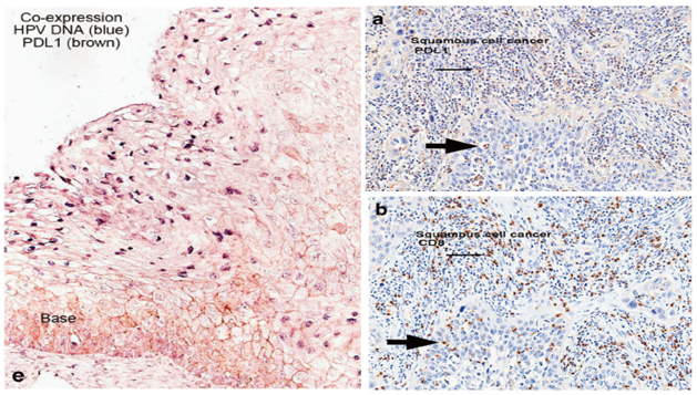 HPV、EBV、HBV等病毒相关性肿瘤免疫微环境及治疗措施医药新闻-ByDrug-一站式医药资源共享中心-医药魔方