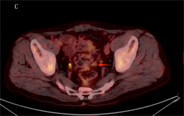 FAPI-PET/CT：精准捕捉腹膜转移癌的“神探”医药新闻-ByDrug-一站式医药资源共享中心-医药魔方