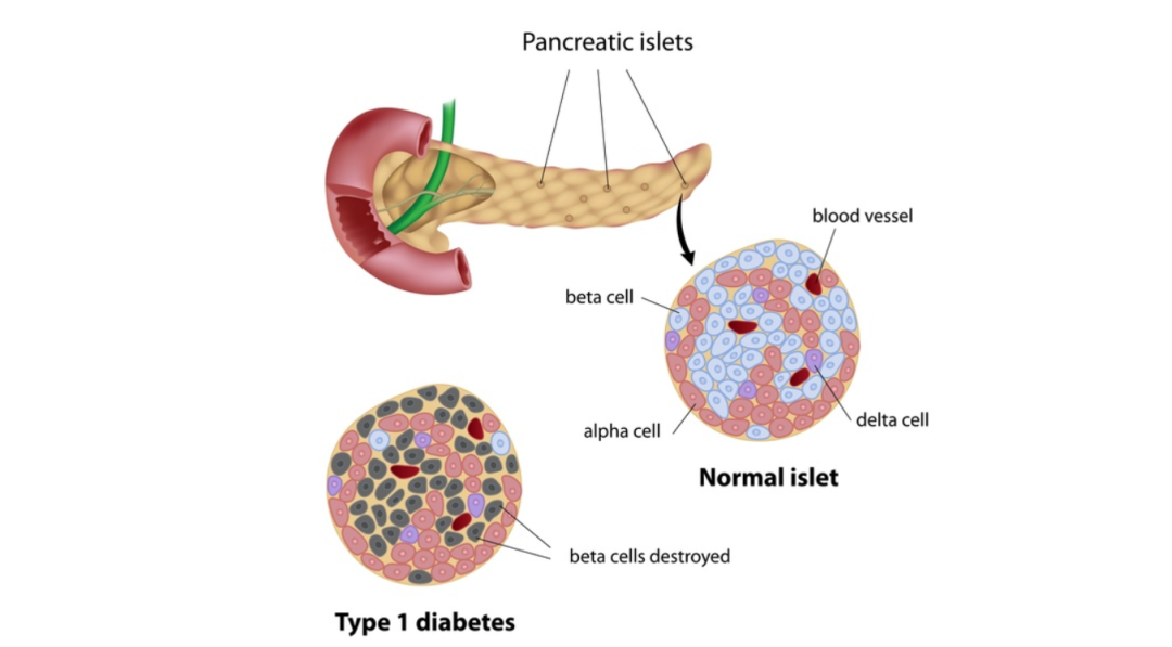 告别胰岛素注射，细胞疗法VX-880治疗糖尿病Ⅰ/Ⅱ期临床数据亮眼医药新闻-ByDrug-一站式医药资源共享中心-医药魔方