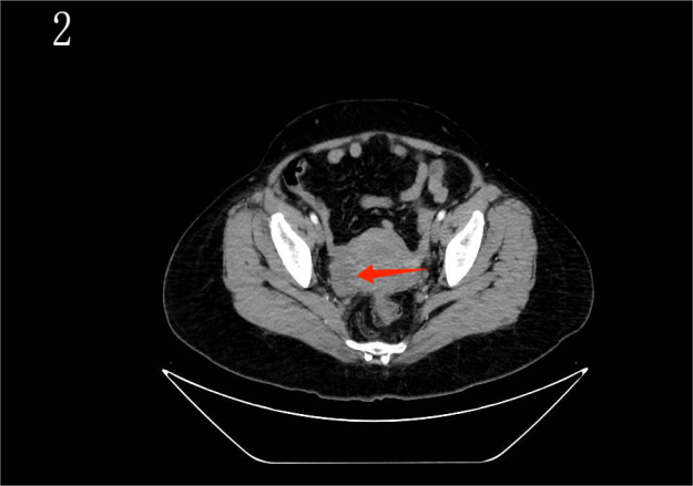 FAPI-PET/CT：精准捕捉腹膜转移癌的“神探”医药新闻-ByDrug-一站式医药资源共享中心-医药魔方