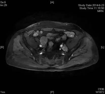 [MDT病例讨论]盆腔淋巴结转移的前列腺癌1例医药新闻-ByDrug-一站式医药资源共享中心-医药魔方