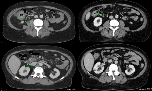 4例临床实例与进展梳理，探dMMR/MSI-H结直肠癌免疫转化治疗疗效与潜力医药新闻-ByDrug-一站式医药资源共享中心-医药魔方