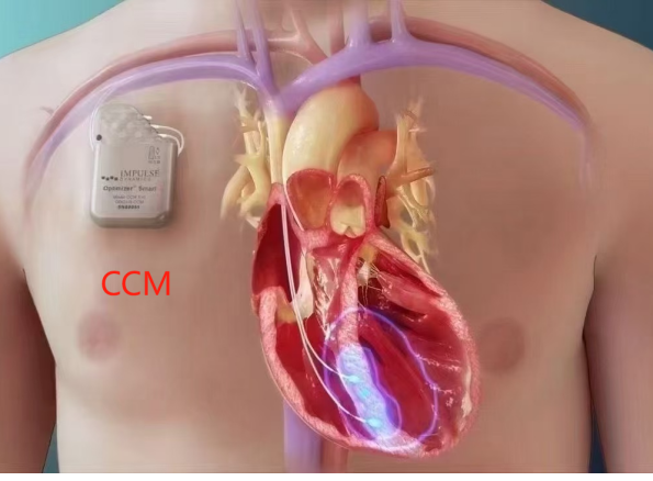 上海首例！为衰弱心脏装上“双保险”！东方心内完成CCM+S-ICD一站式手术医药新闻-ByDrug-一站式医药资源共享中心-医药魔方