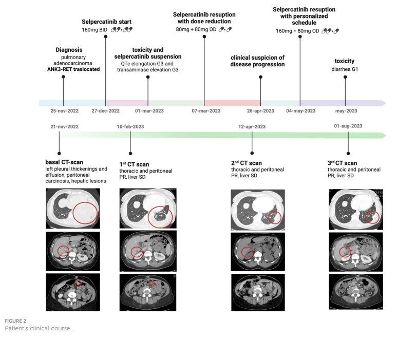 首例：剂量调整的塞普替尼一线治疗ANK3::RET融合阳性NSCLC疗效显著医药新闻-ByDrug-一站式医药资源共享中心-医药魔方