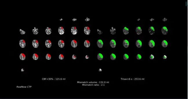 医未AI卒中获批NMPA三类证｜道彤Family医药新闻-ByDrug-一站式医药资源共享中心-医药魔方