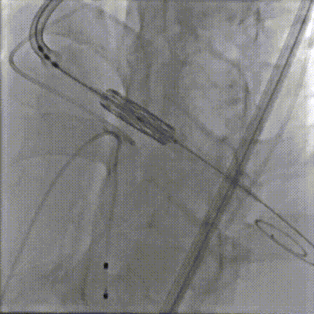 吉林省首例！吉林大学第一医院心血管内科团队应用SAPIEN 3¹瓣膜成功完成一例大瓣环Type0型二叶瓣TAVR手术医药新闻-ByDrug-一站式医药资源共享中心-医药魔方