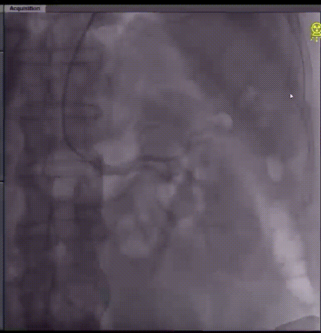 桡股双选 效安久远｜浙江大学医学院附属第二医院成功完成全球首款经桡RDN系统上市后临床应用！医药新闻-ByDrug-一站式医药资源共享中心-医药魔方