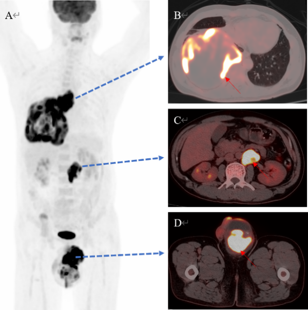 【特色技术】探测肿瘤的利器—肿瘤诊断界的“福尔摩斯” ——全身PET/CT医药新闻-ByDrug-一站式医药资源共享中心-医药魔方