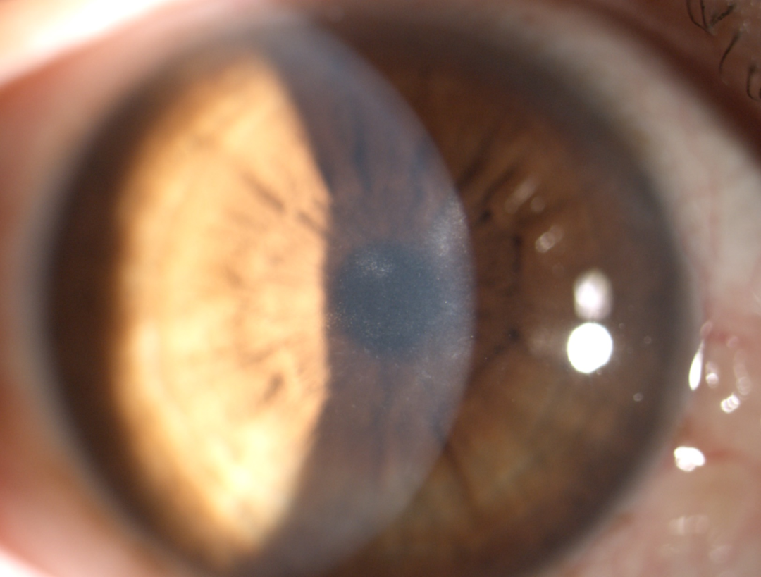 【光热脉动真实世界】MGD干眼：iLux 睑板腺光热脉动联合治疗效果显著医药新闻-ByDrug-一站式医药资源共享中心-医药魔方