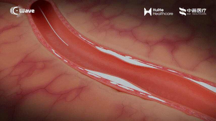 Sherpa Friends | 夏尔巴投资企业汇禾医疗C-Wave®冠脉冲击波导管获批上市医药新闻-ByDrug-一站式医药资源共享中心-医药魔方