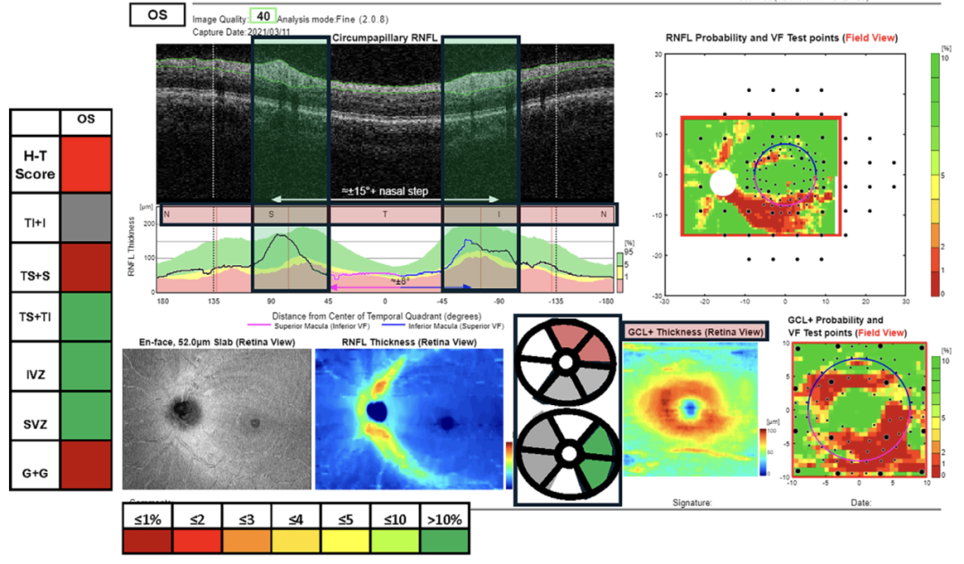 新OCT指标（新模型）：为疑似青光眼患者提供有效转诊依据医药新闻-ByDrug-一站式医药资源共享中心-医药魔方