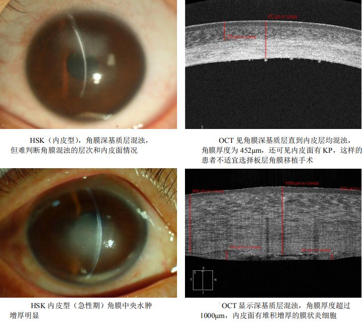 角膜解剖和OCT检查医药新闻-ByDrug-一站式医药资源共享中心-医药魔方