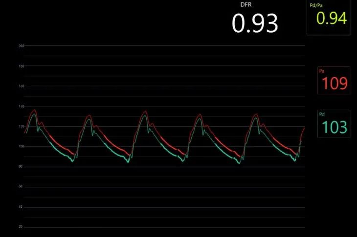 国内首例！医院心内科张必利教授团队利用DFR测定诊断新技术为冠心病患者提供精准诊疗医药新闻-ByDrug-一站式医药资源共享中心-医药魔方