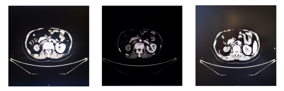 高级别UTUC系统治疗 ADC+IO 再创神奇疗效医药新闻-ByDrug-一站式医药资源共享中心-医药魔方