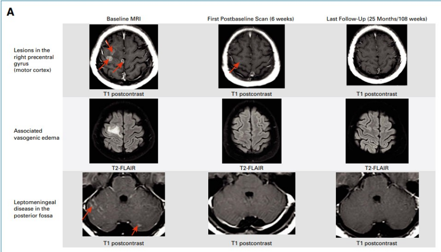 【3866】范云教授：FLAURA2 CNS 数据登陆JCO，卓越疗效数据再度被国际认可医药新闻-ByDrug-一站式医药资源共享中心-医药魔方